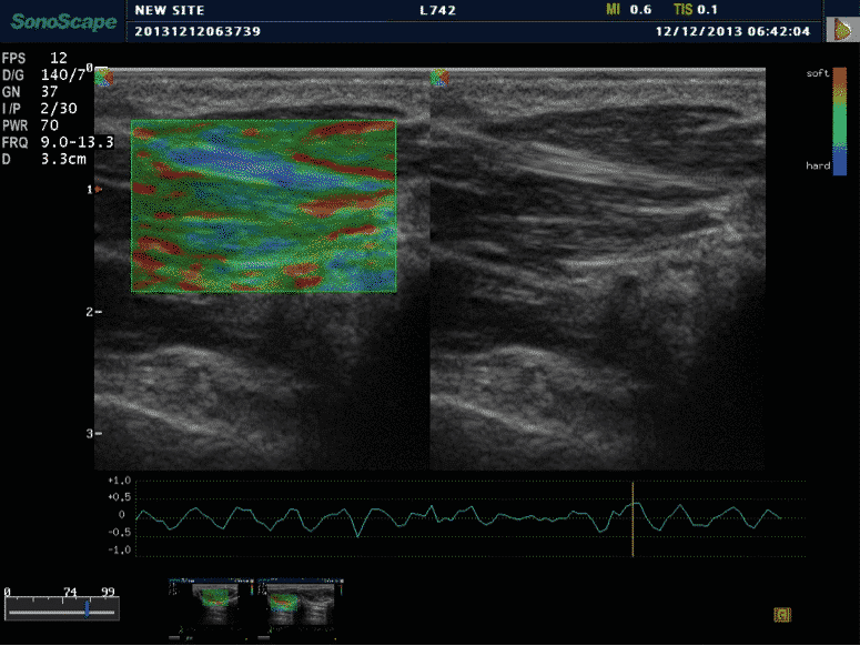 The Benefits of Elastography in Ultrasound | Probo Medical